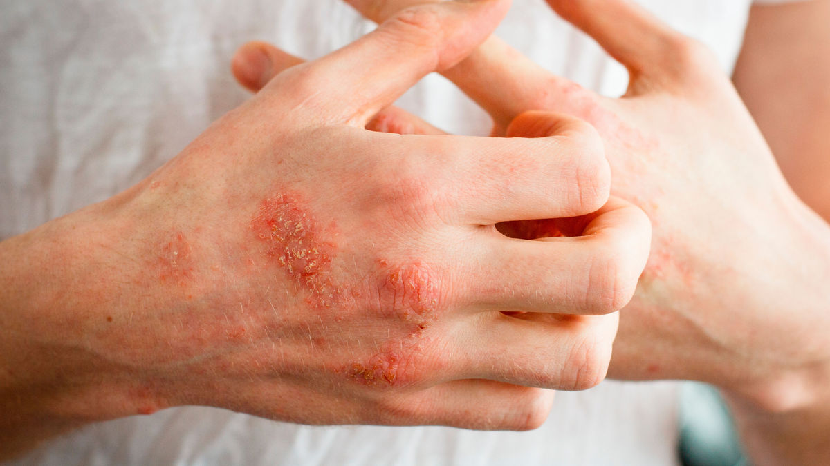 Handekzem – Ursachen, Symptome & Therapie