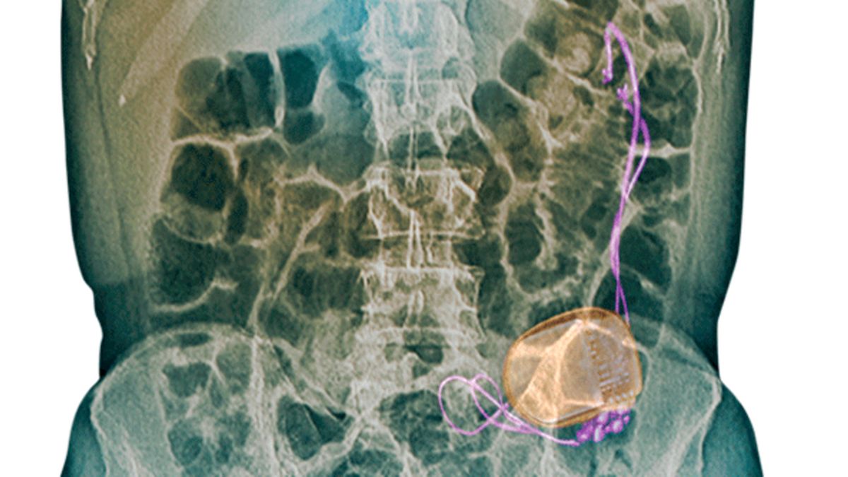 Gastroparese: Welche Therapieoptionen stehen zur Verfügung?