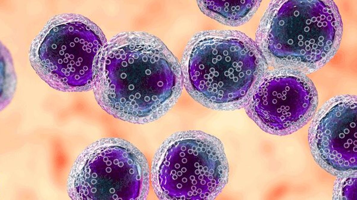 Burkitt-Lymphom: Übersicht zu Epidemiologie, Diagnostik und Behandlung