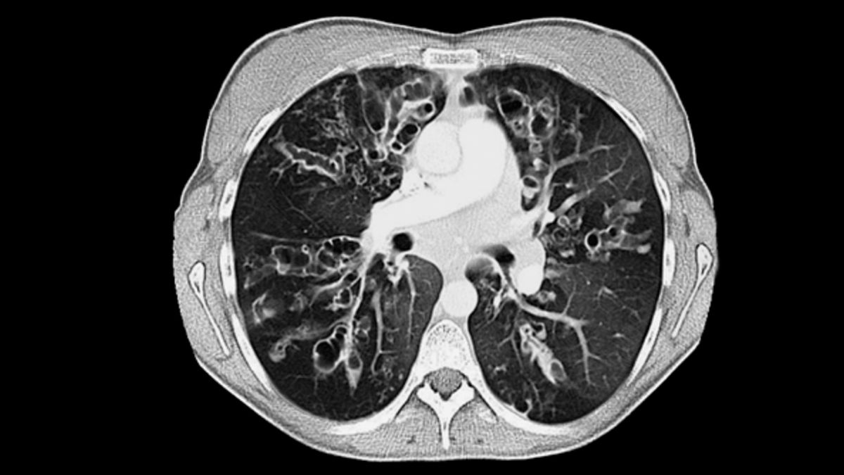 Zystische Fibrose: Duale CFTR-Modulation bewährt sich auch im Dauereinsatz