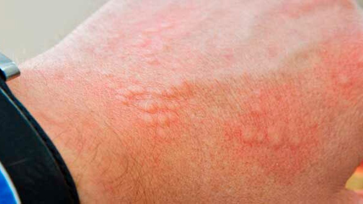 Nesseln, Quaddeln, Ödeme: Pathogenese von chronischer Urtikaria und ...