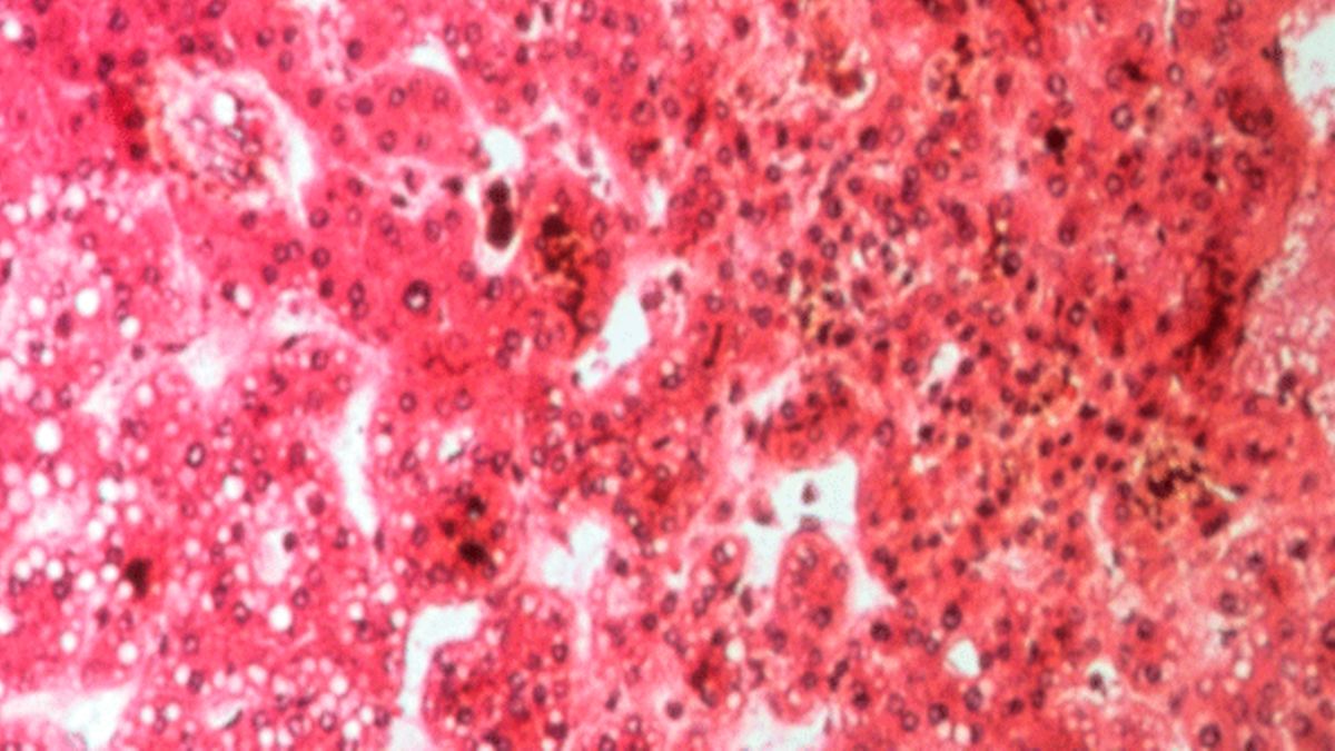 Autoimmunhepatitis: Fast jeder dritte Betroffene hat schon bei ...