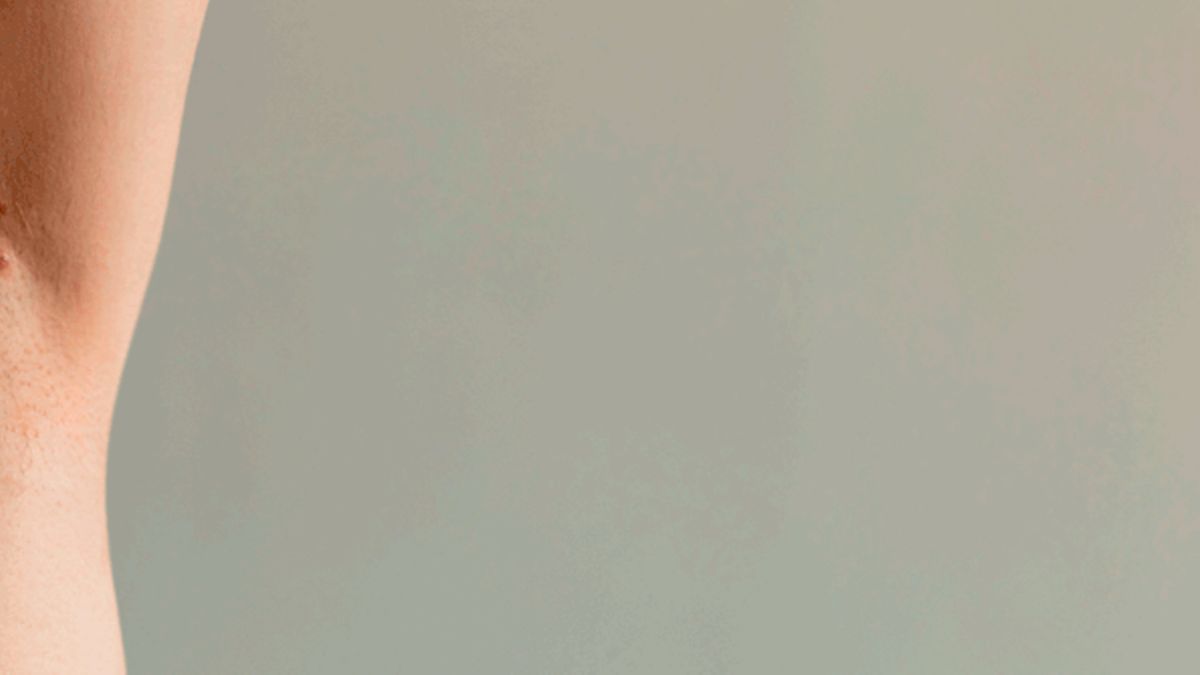 Acne inversa: Erhöhte Prävalenz der Fibromyalgie