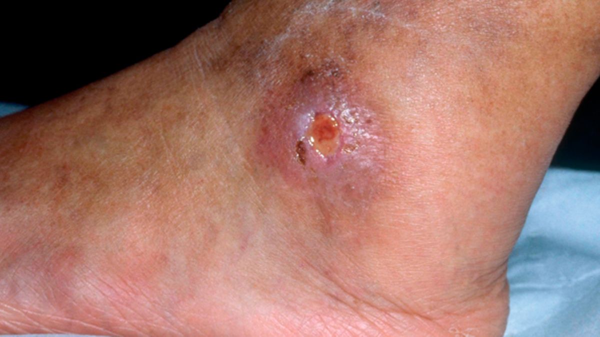 Ulkus cruris venosum: Kompressionstherapie und invasive Verfahren ...