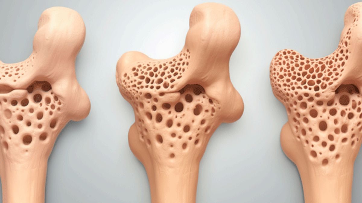 Osteopenie: Wann ist eine Therapie wirklich nötig?