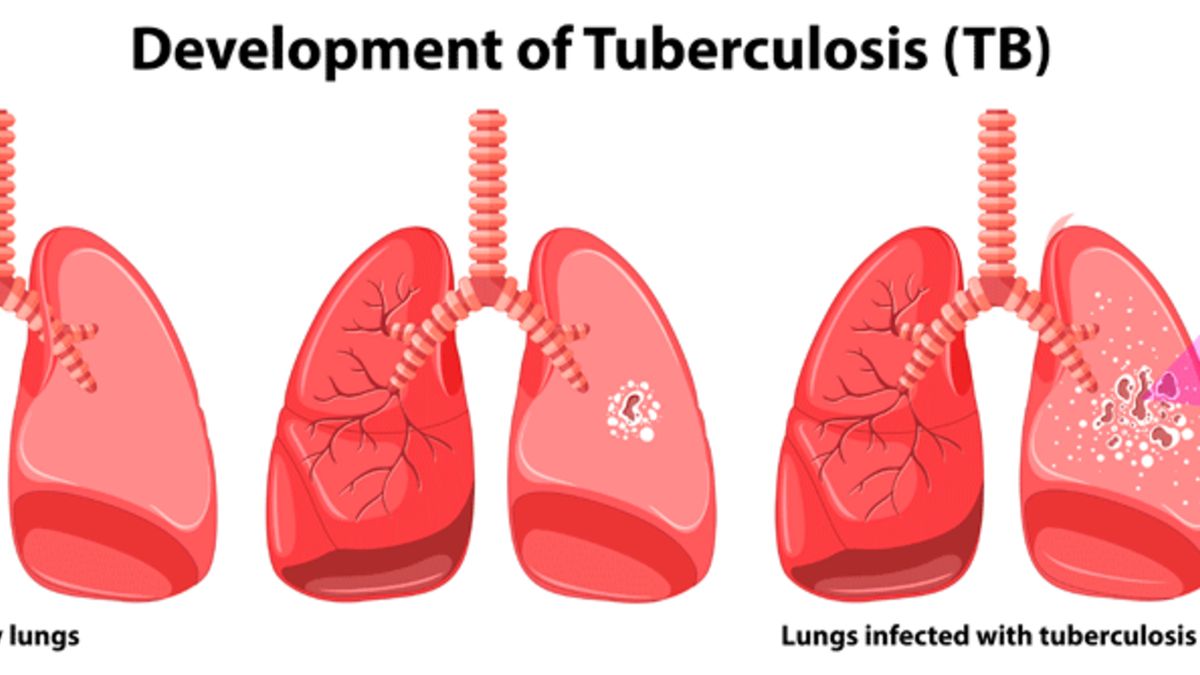MDR-TB: Sutezolid und Delpazolid schlagen Linezolid