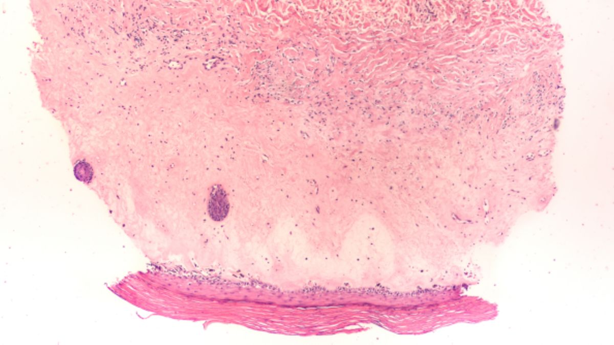 Die frühzeitige Diagnose eines Lichen sclerosus erspart viel Leid