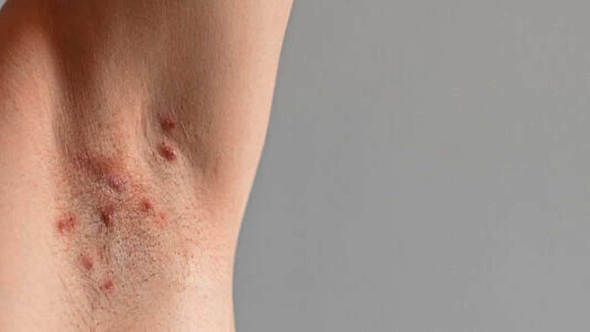 Acne inversa: Antibiotikatherapie wirkt!