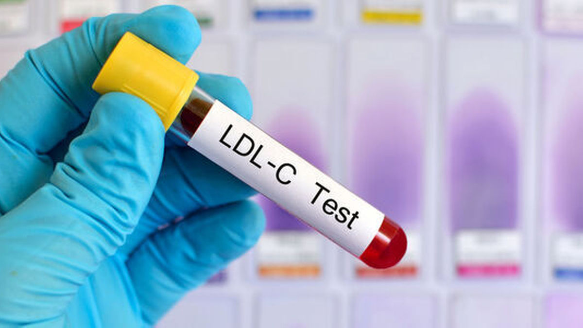 Neues in Sachen LDL-Cholesterin: „Es lohnt sich, zu klotzen“