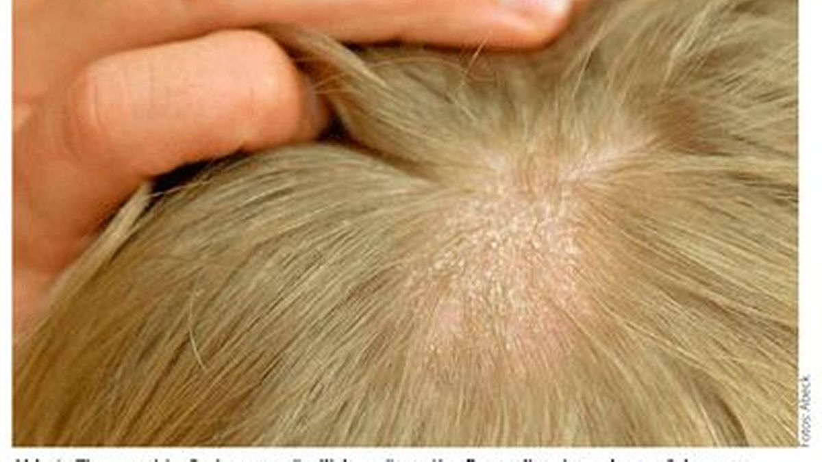 Pilzinfektionen: Aufgepasst bei Kopf und Nägeln!