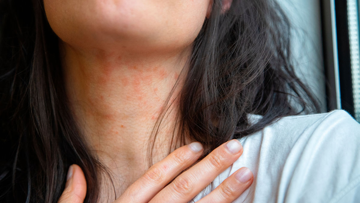 Atopische Dermatitis langfristig lindern
