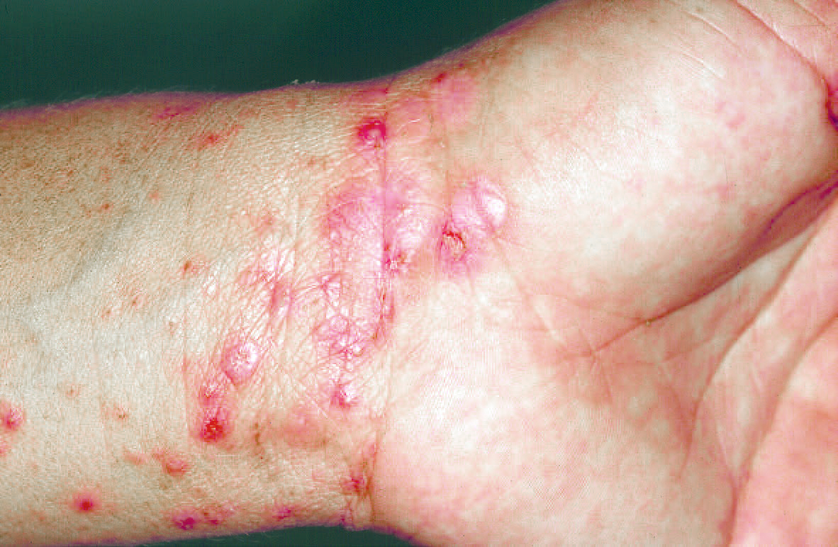Bei Skabies-Verdacht auf die Klinik verlassen - Medical Tribune