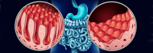 Zöliakie: Enteroviren, die Darmzotten minimieren?