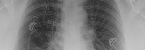 Dem Emphysem die Luft abdrehen – neue interventionelle Verfahren zur ...