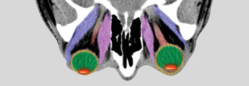 Diagnostik und Therapie des Morbus Basedow