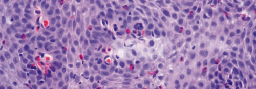 EoE biologisch angehen