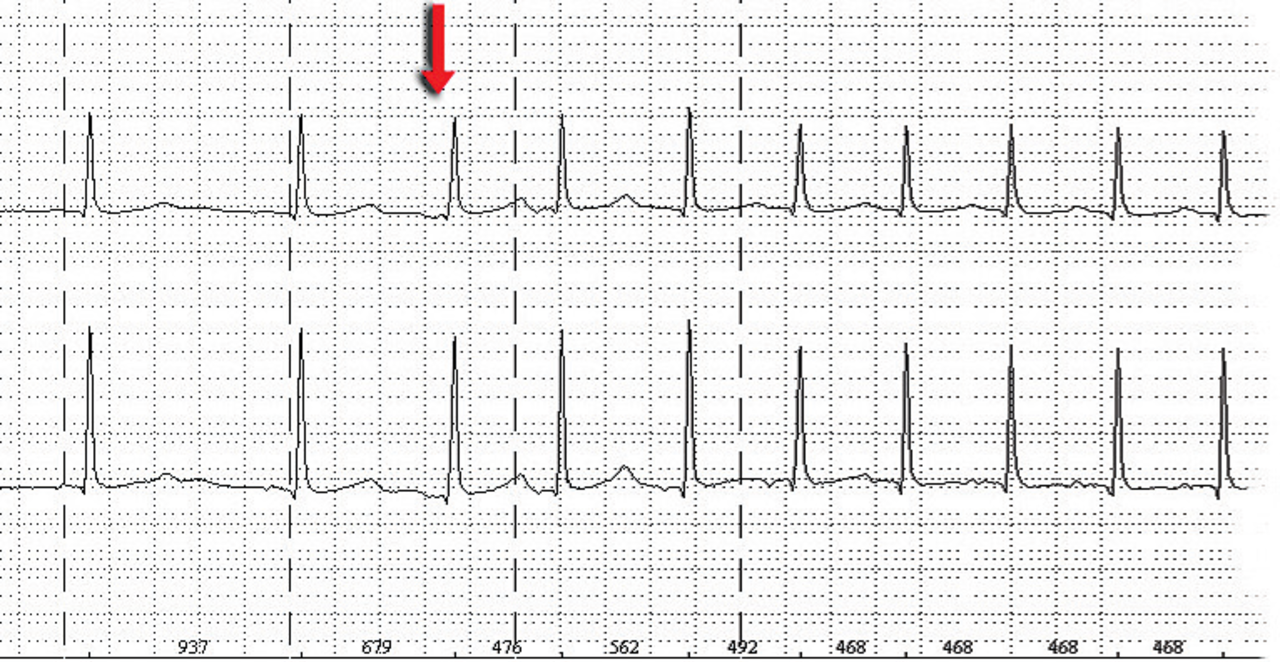 Supraventrikuläre Tachykardien: Medikamentöse Behandlung oder ...