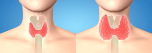 Hyperthyreose: TSH normalisieren senkt das Frakturrisiko ...