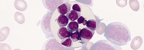 ATRA plus Decitabin bei AML erfolgreich