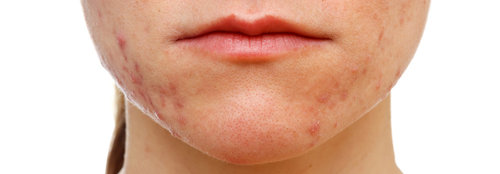 Neues Wirkprinzip bei Akne dank Androgeninhibitor