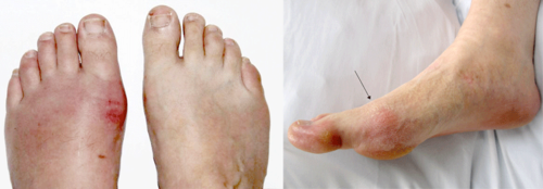 Gicht: Akuttherapie und Anfallsprophylaxe