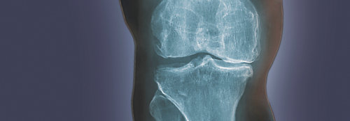Gonarthrose – Was tun, wenn’s im Knie knirscht?