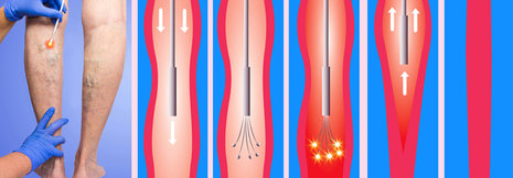 Laserablation der Varizen fördert Rezidive
