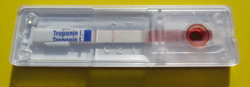 Normales Troponin als Risikofaktor für bislang Herzgesunde