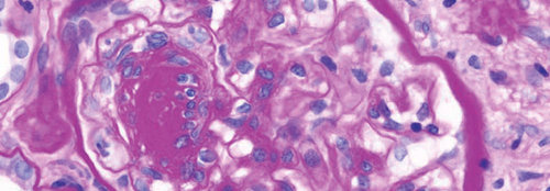 Diabetische Nephropathie: Finerenon bremst Progression