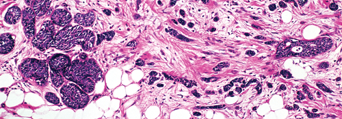 Metastasiertes triple-negatives Mammakarzinom – klarer Benefit für ...