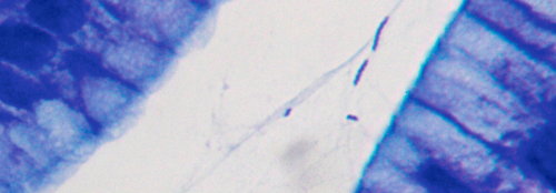 Helicobacter heilmannii verursachte Gastritis