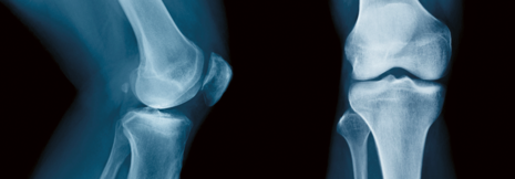 Wie sich die Koxarthrose konservativ behandeln lässt