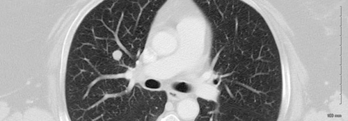 Solide und subsolide Lungenherde im CT korrekt abklären