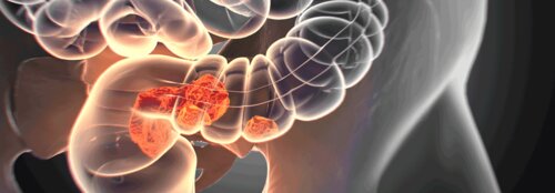 Zusätzliches Bevacizumab steigerte in der SUNSHINE-Studie die ...