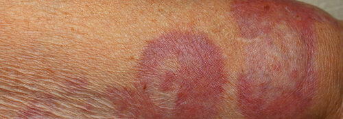 Ulzerationen an den Akren als charakteristisches Merkmal